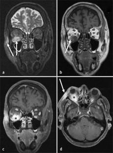 Diagnose und Differenzialdiagnose der endokrinen Orbitopathie in der ...