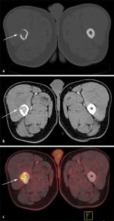 Radiologische Diagnostik des multiplen Myeloms | SpringerLink