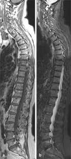 Radiologische Diagnostik des multiplen Myeloms | SpringerLink