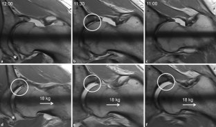 Impingement der Hüfte | SpringerLink