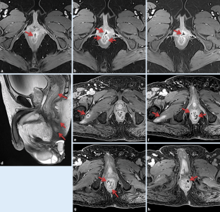 Perianale entzündliche Erkrankungen | SpringerLink