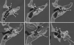 Anatomie des Felsenbeins | SpringerLink