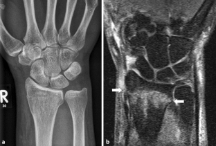 Spezielle Aspekte der Frakturen am distalen Unterarm | SpringerLink