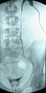 Singuläres Ileuminterponat mit beidseitiger Harnleiterimplantation nach ...