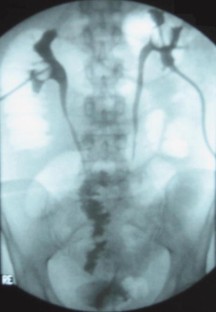 Singuläres Ileuminterponat mit beidseitiger Harnleiterimplantation nach ...