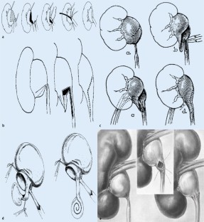 Nierenbeckenplastik – pro laparoskopisch | SpringerLink