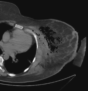 Ausgedehnter Abszess der Mamma | SpringerLink