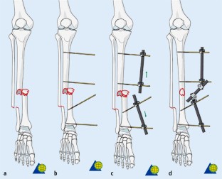 Fixateur-externe-Osteosynthese | SpringerLink
