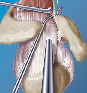 Nervenkompressionssyndrome der Schulter | SpringerLink