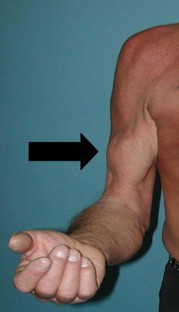 Proximale und distale Ruptur des M. biceps brachii | SpringerLink