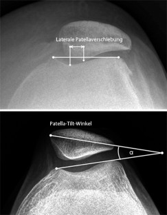 Das schmerzhafte Patellofemoralgelenk | SpringerLink