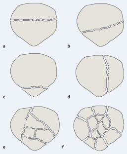 Einteilung und Therapie der Patellafraktur | SpringerLink