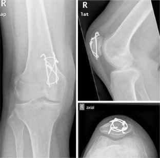 Einteilung und Therapie der Patellafraktur | SpringerLink