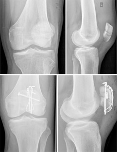 Einteilung und Therapie der Patellafraktur | SpringerLink