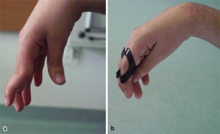 Unilaterale spastische Zerebralparese (Hemiparese) | SpringerLink