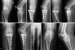 Outcome und Komplikationen nach proximalen Tibiafrakturen | SpringerLink