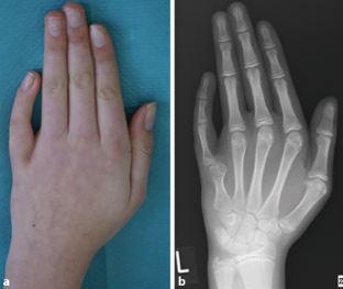 Fehlbildungen an Hand und Unterarm | SpringerLink