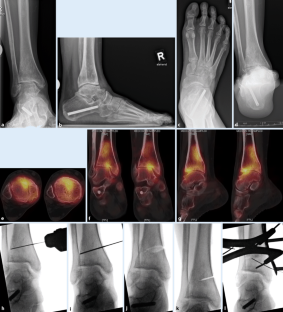 Supramalleolare Osteotomie bei asymmetrischer Arthrose des oberen ...