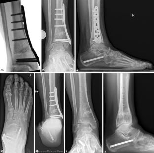 Supramalleolare Osteotomie bei asymmetrischer Arthrose des oberen ...