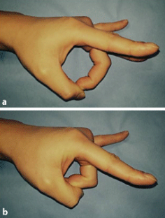 Direct repair of the sagittal band for extensor tendon subluxation ...