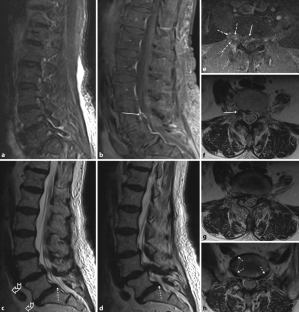 Moderne radiologische Diagnostik in der Wirbelsäulenchirurgie ...