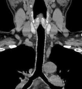 Steeple sign and narrowed upper airway in an influenza patient ...