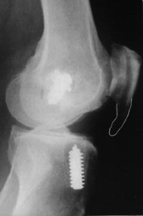 Calcification of the patellar tendon after ACL reconstruction ...