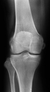 Symptomatic calcification of the medial collateral ligament of the knee ...