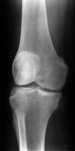 Symptomatic calcification of the medial collateral ligament of the knee ...