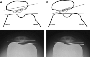 Radiographic features predictive of patellar maltracking during total ...