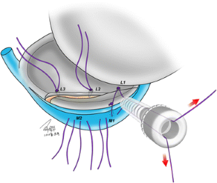 A new “double-pulley” dual-row technique for arthroscopic fixation of ...