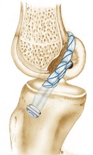 Over-the-top double-bundle revision ACL reconstruction | SpringerLink