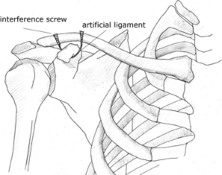 Evaluation of the coracoclavicular reconstruction using LARS artificial ...