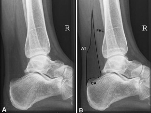 The appearance of the pre-Achilles fat pad after endoscopic ...