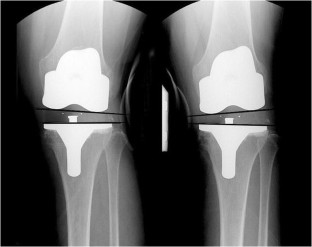 Total knee arthroplasty using ultra-congruent inserts can provide ...