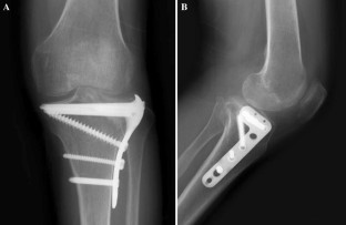 Immediate arthroscopy following ORIF for tibial plateau fractures ...