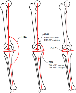 Highly variable coronal tibial and femoral alignment in osteoarthritic ...