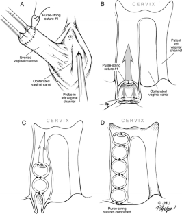 Surgical repair of recurrent prolapse after LeFort colpocleisis ...