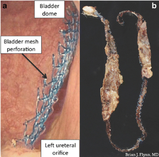 Surgical management of lower urinary mesh perforation after mid ...