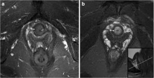 MRI of female urethra and periurethral pathologies | SpringerLink
