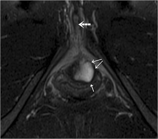 MRI of female urethra and periurethral pathologies | SpringerLink