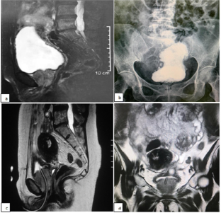 Voiding dysfunction due to female urethral carcinoma | SpringerLink