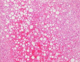 Fettleber und Fettembolie | SpringerLink