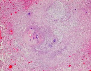 Fettleber und Fettembolie | SpringerLink