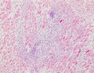 Fettleber und Fettembolie | SpringerLink