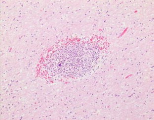 Fettleber und Fettembolie | SpringerLink