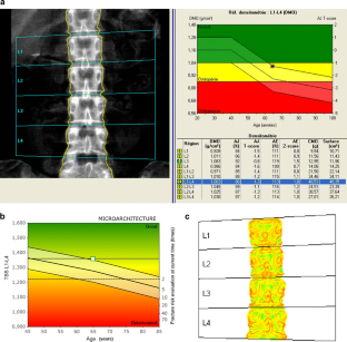 Trabecular bone score (TBS): available knowledge, clinical relevance ...