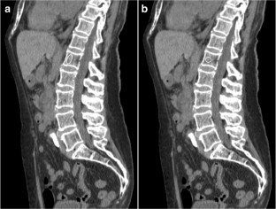 Using opportunistic screening with abdominal CT to identify ...