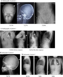 Novel Mutations in PLOD2 Cause Rare Bruck Syndrome | SpringerLink