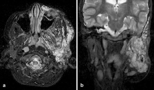 MRI growth patterns of plexiform neurofibromas in patients with ...